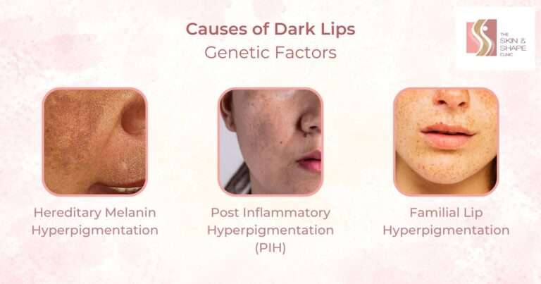 Dark Lips Treatment by Dermatologist - The Skin & Shape