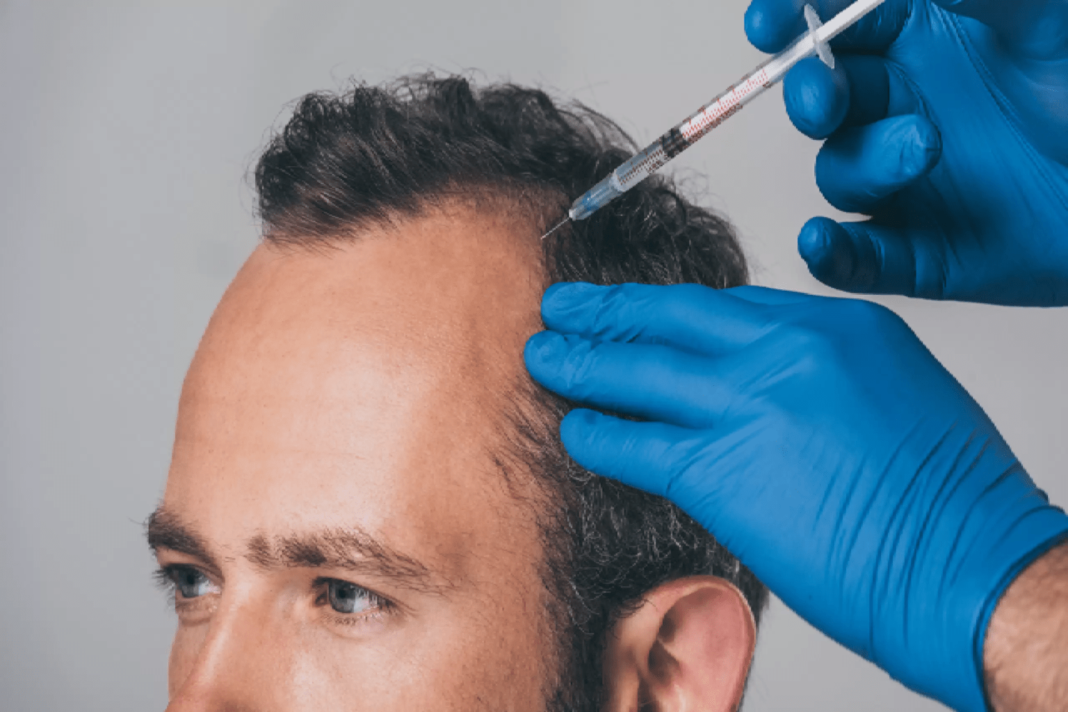 Explore Latest Advances in Mesotherapy Treatments for Men