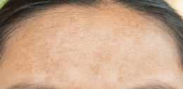 Pigmentation on Forehead: Causes, Treatment, and Prevention