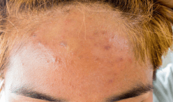 Pigmentation on Forehead: Causes, Treatment, and Prevention