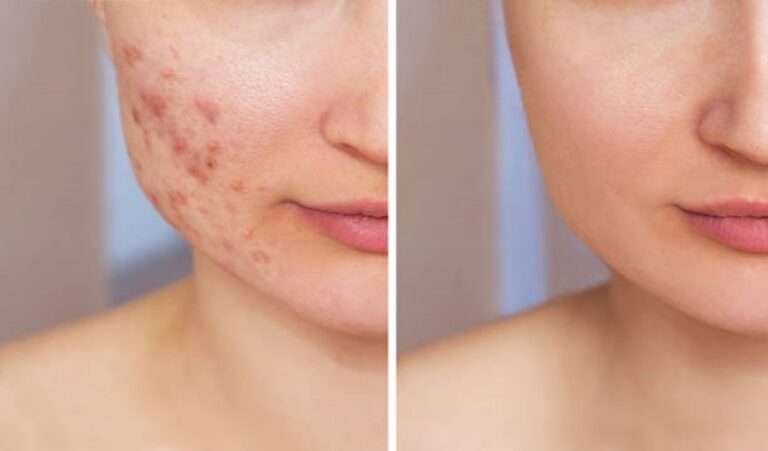 Q Switch Laser Treatment in Mumbai - View Cost| Skin & Shape