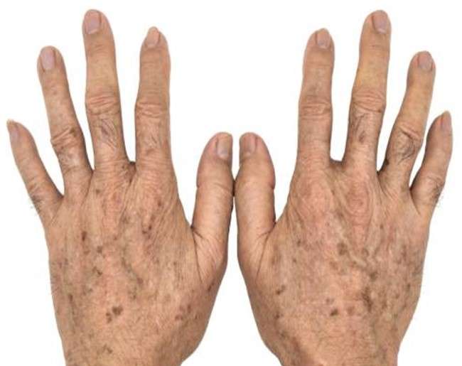 Q Switch Laser Treatment in Mumbai - View Cost| Skin & Shape