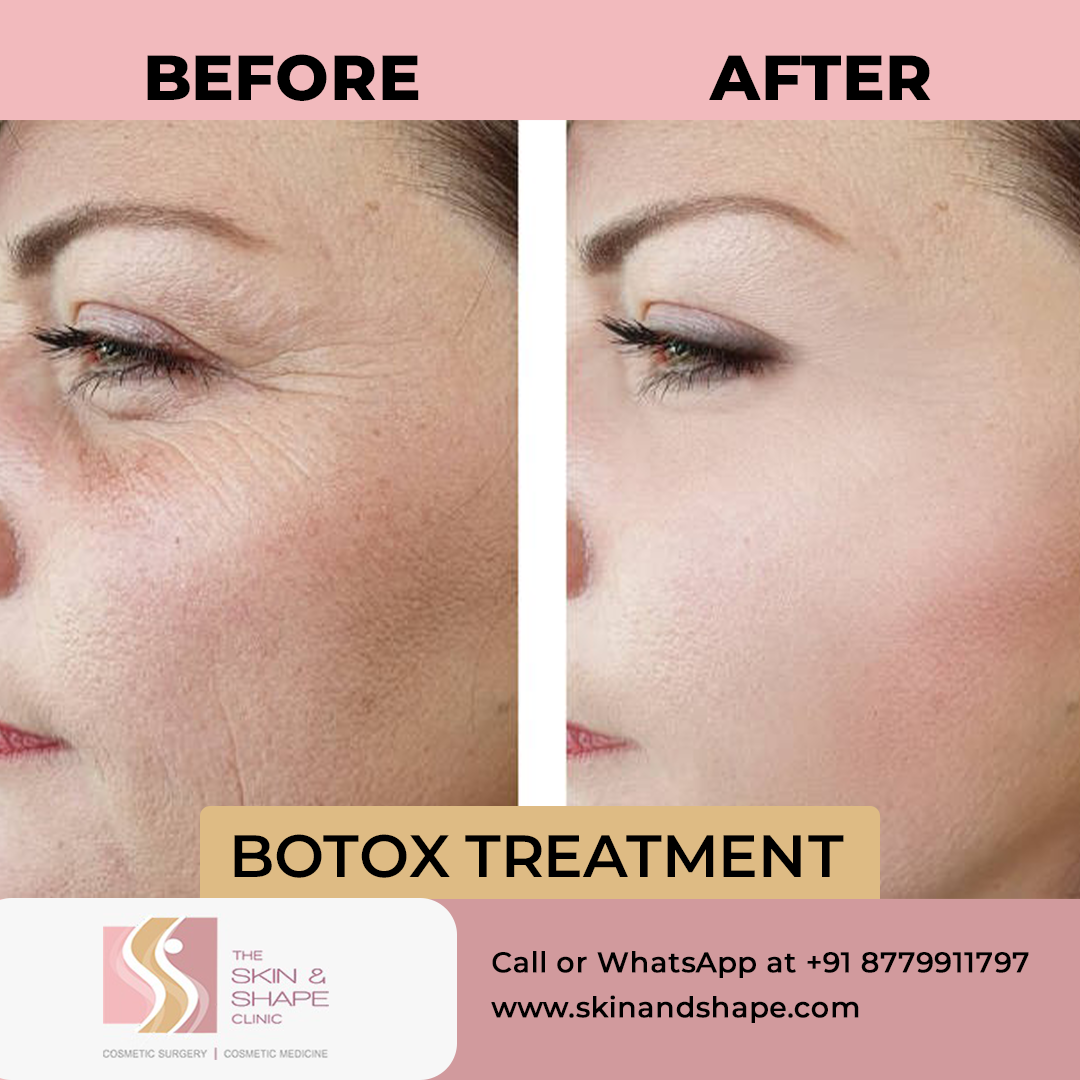 Botox Treatment in Mumbai | Dr. Anju Methil