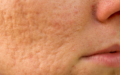 Acne Scar Removal Treatment in Andheri, Mumbai |Skin & Shape